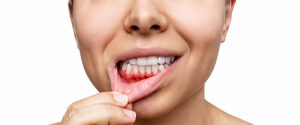 Bleeding Gums While Brushing: When to Worry & What to Do