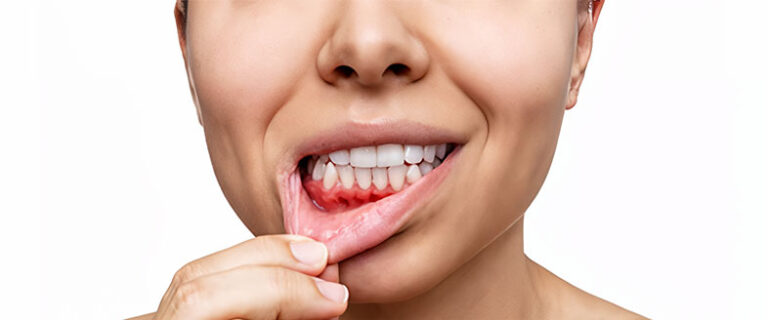 Bleeding Gums While Brushing: When to Worry & What to Do